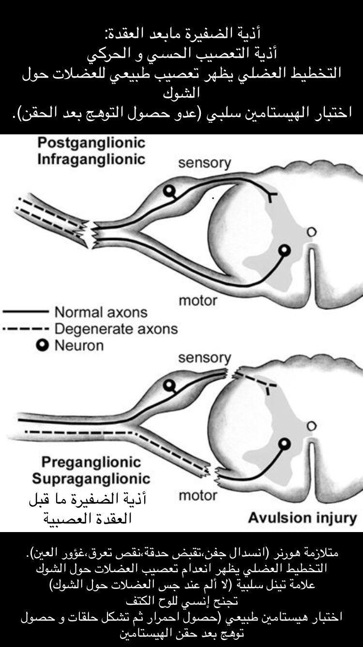Pre vs. Post ganglionic brachial plexus injury – Let's Talk Ortho