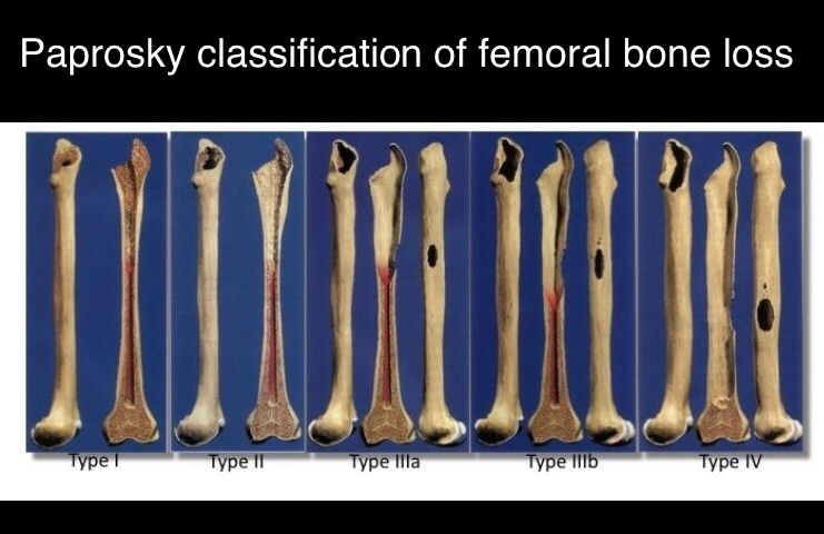 Paprosky classification of Femoral and Acetabular bone loss – Let's ...