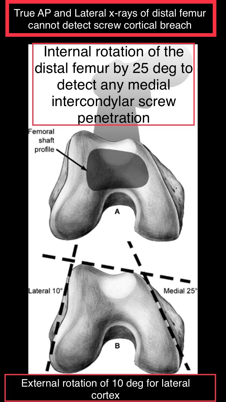 Distal femoral fracture – Let's Talk Ortho